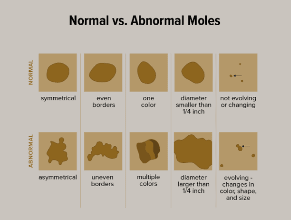 Tips for Early Detection of Skin Cancer | Roots Health DPC